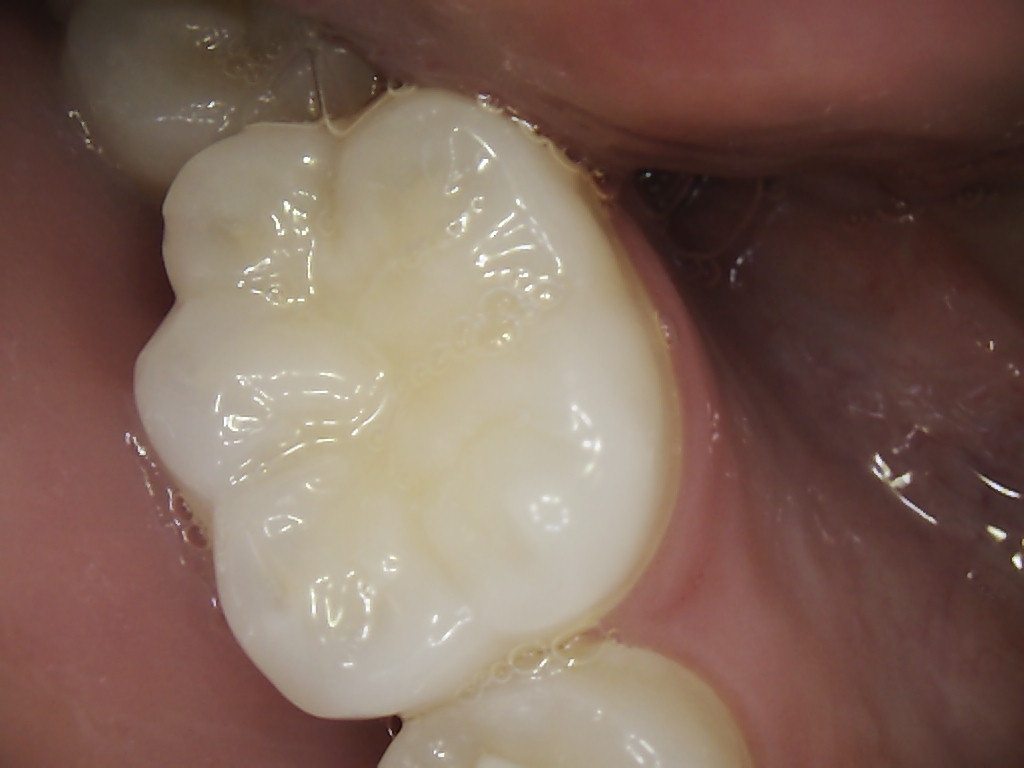 Preventing and Treating Cavities | MFDC